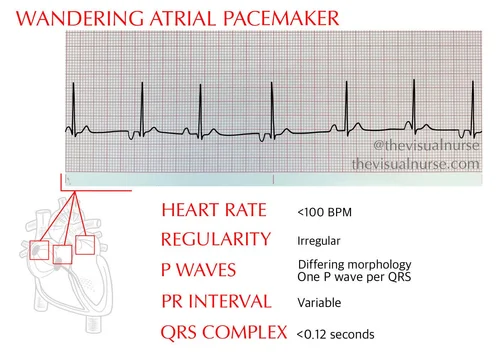 WAP vs. MAT on ECG: What’s the difference? — The Visual Nurse