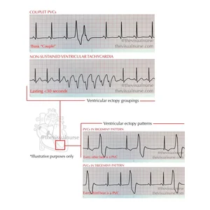 Ventricular bigeminy (PVCs in bigeminy) on ECG for new nurses and ...