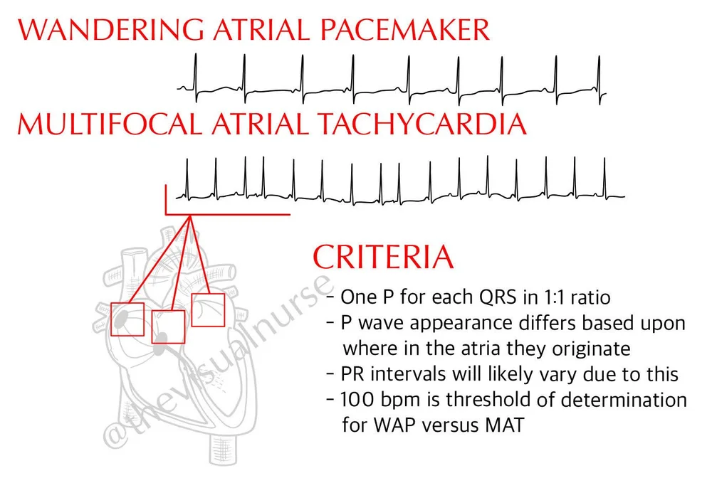 WAP vs. MAT on ECG: What’s the difference? — The Visual Nurse