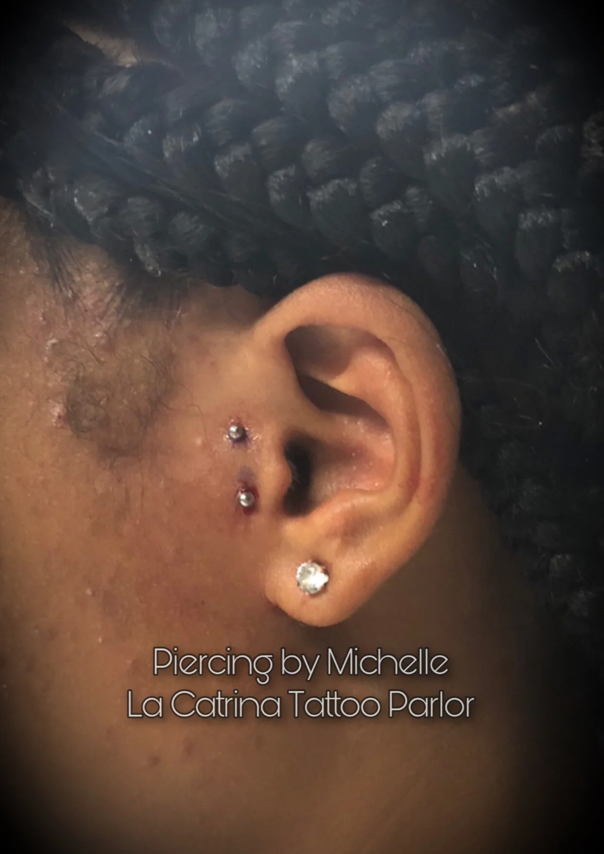 Vertical Surface Tragus