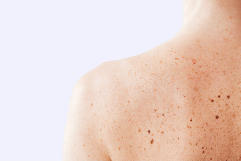 Hudkreft og solskader — Bryggen Hudlegesenter