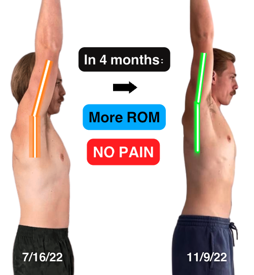 How Alvaro Overcame Pain From a Shoulder Impingement, Disc Herniation ...