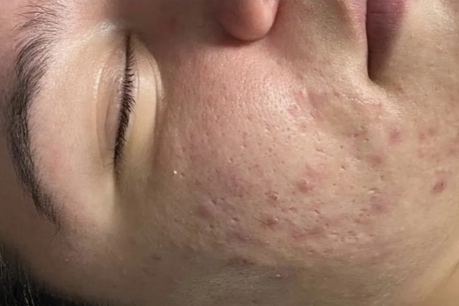 Face Reality Acne Bootcamp — BONAVITA AESTHETICS