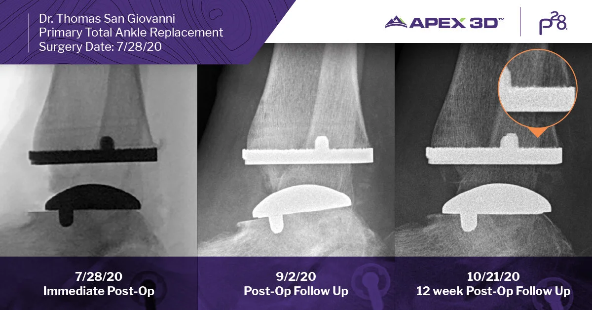 surgeon — APEX 3D™ Total Ankle Replacement System