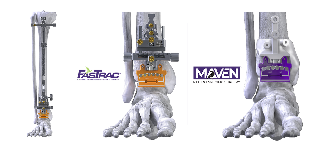 surgeon — APEX 3D™ Total Ankle Replacement System