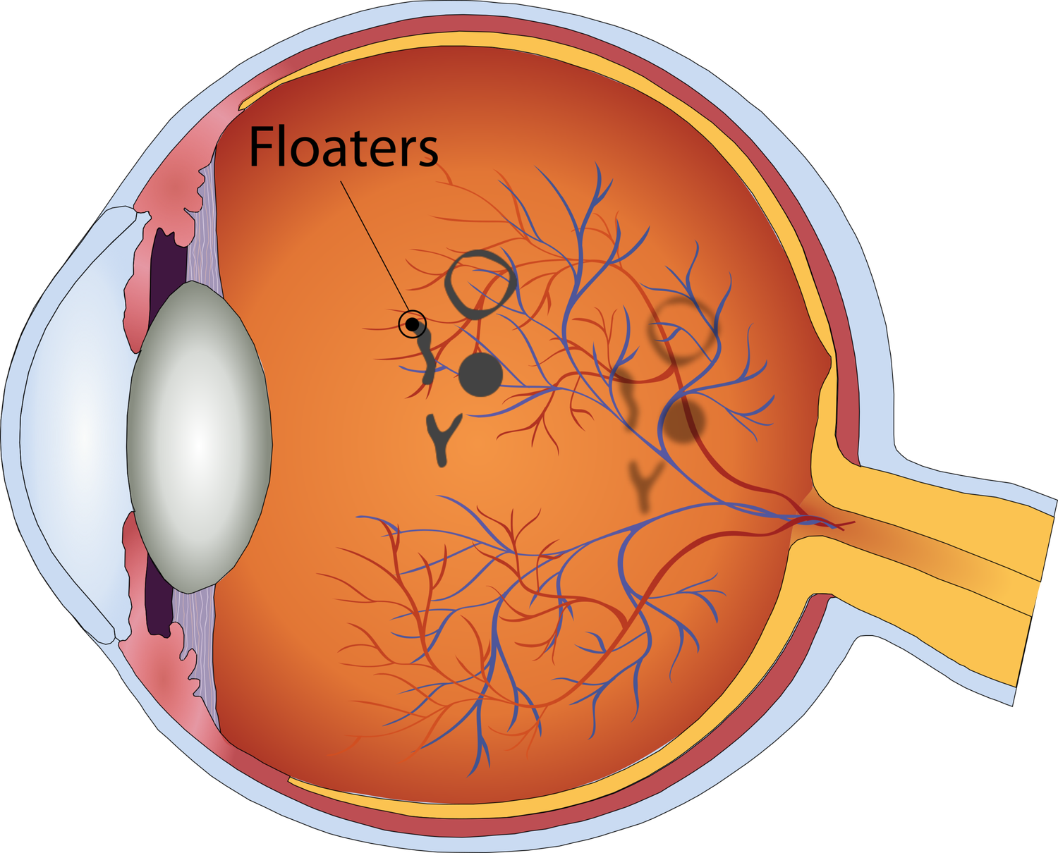 Floaters — Puente Hills Eye Care