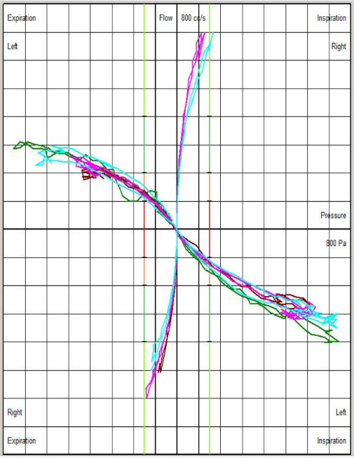 Rhinomanometry — Sleep and Brain