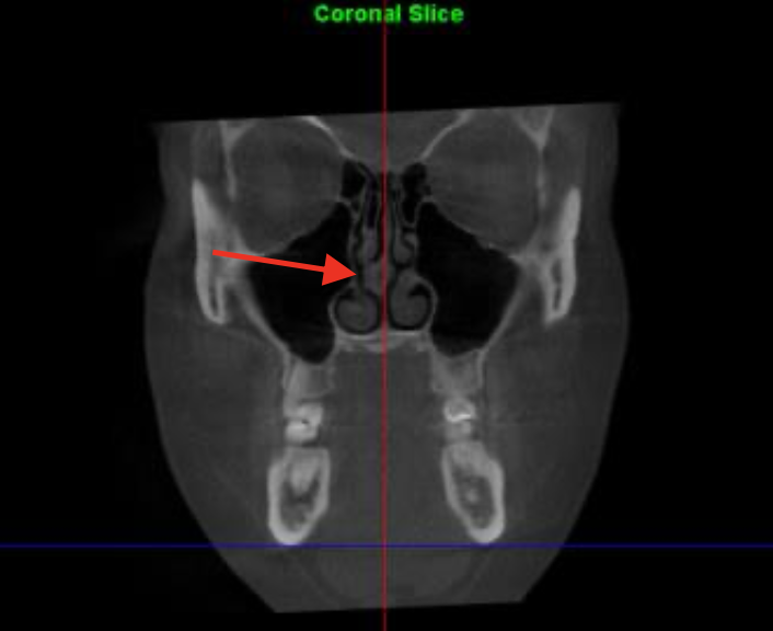 Sleep Apnea — Sleep and Brain