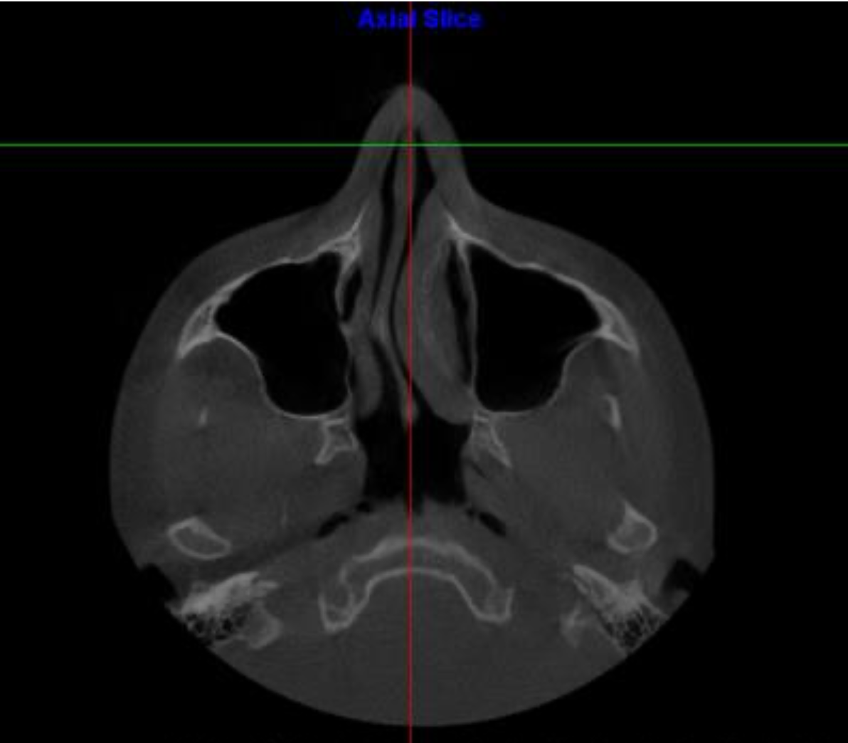 Cone Beam CT — Sleep and Brain