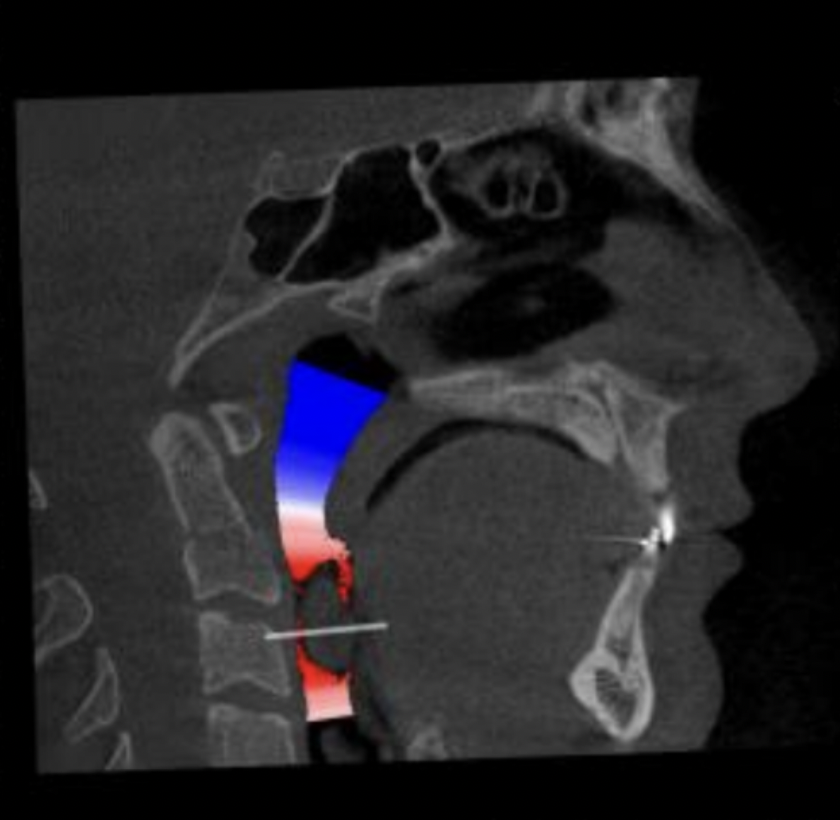Cone Beam CT — Sleep and Brain