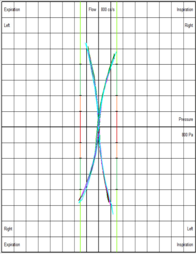 Rhinomanometry — Sleep and Brain