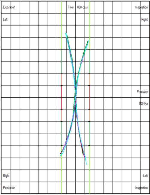Rhinomanometry — Sleep and Brain