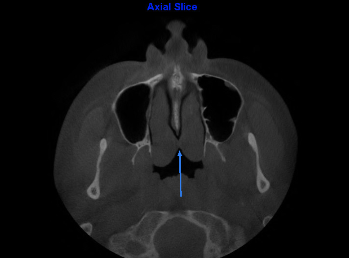 Sleep Apnea — Sleep and Brain