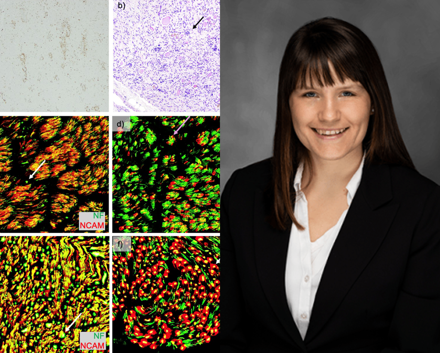 Mitchell Syndrome Research Proceeds at WashU with New Case Report — The ...