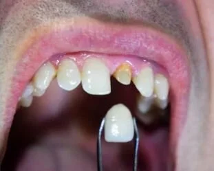 Broken, cracked or missing teeth - Kingston Beach Dental