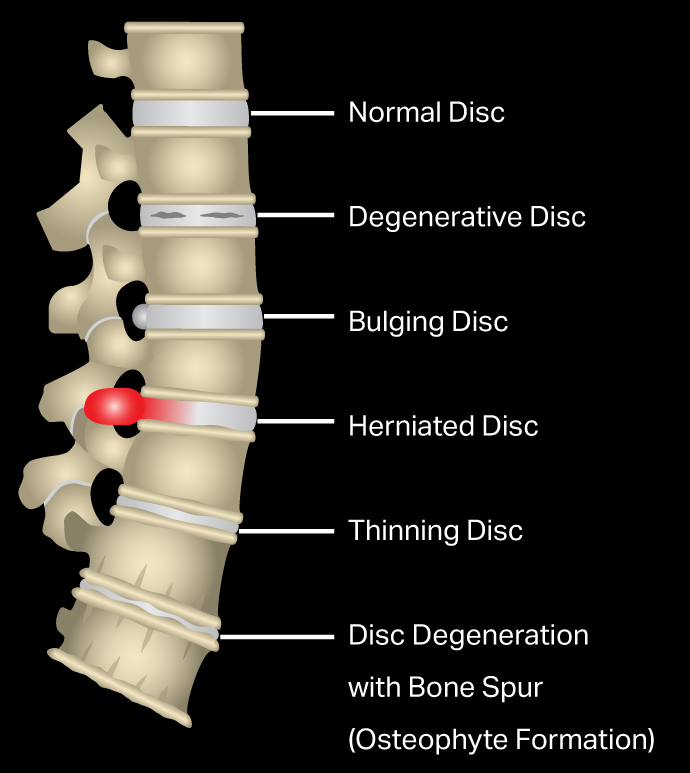 Spine Compression Basics — Laevo Exoskeletons