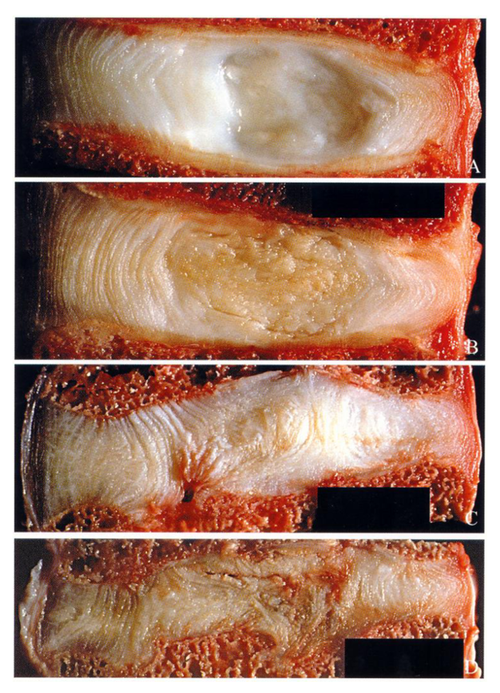 Spine Compression Basics — Laevo Exoskeletons