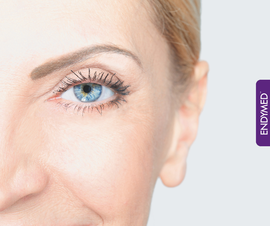 Endymed EndyBleph Specialist Eye Treatment at Attic Medi Spa in Grimsby ...