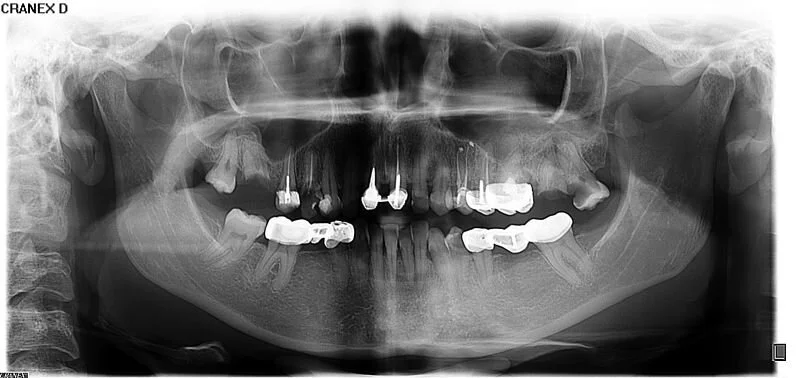 De ce anumite extractii trebuie facute de medicul specialist? — STOMDAS