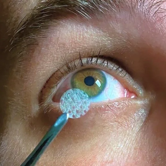 Specialty Contact Lenses — Peak Vision Clinic