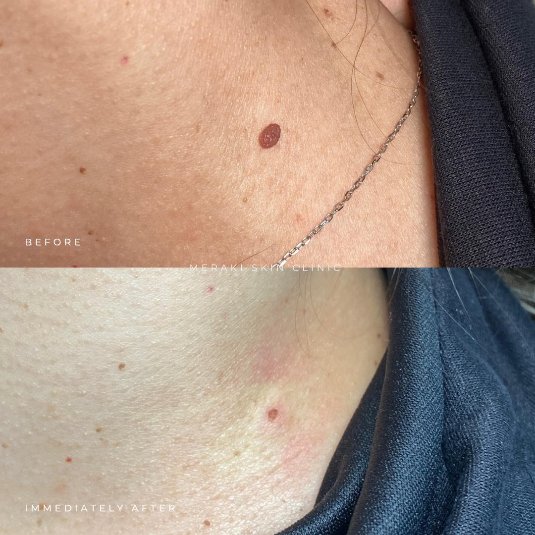 Keloid, Skin Tag Removal — Meraki Skin Clinic