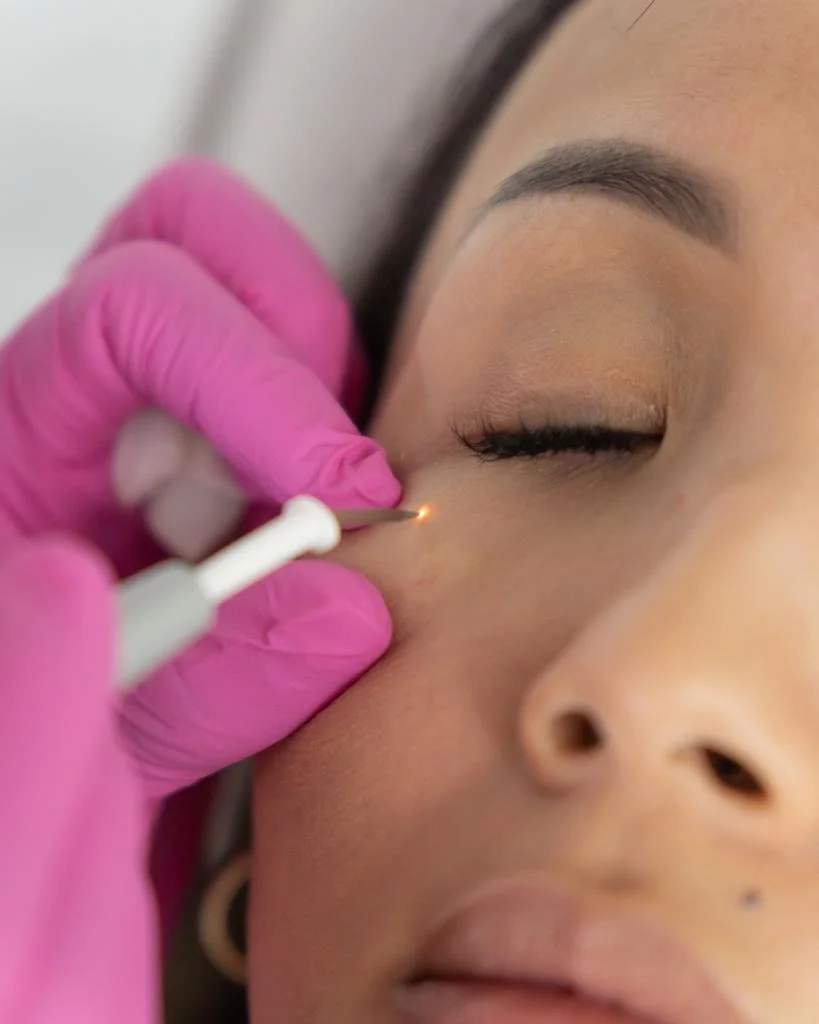 Keloid, Skin Tag Removal — Meraki Skin Clinic