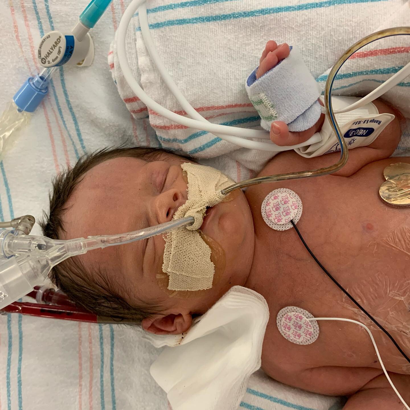Landon's CDH Story — Tiny Hero: Real Hope for CDH