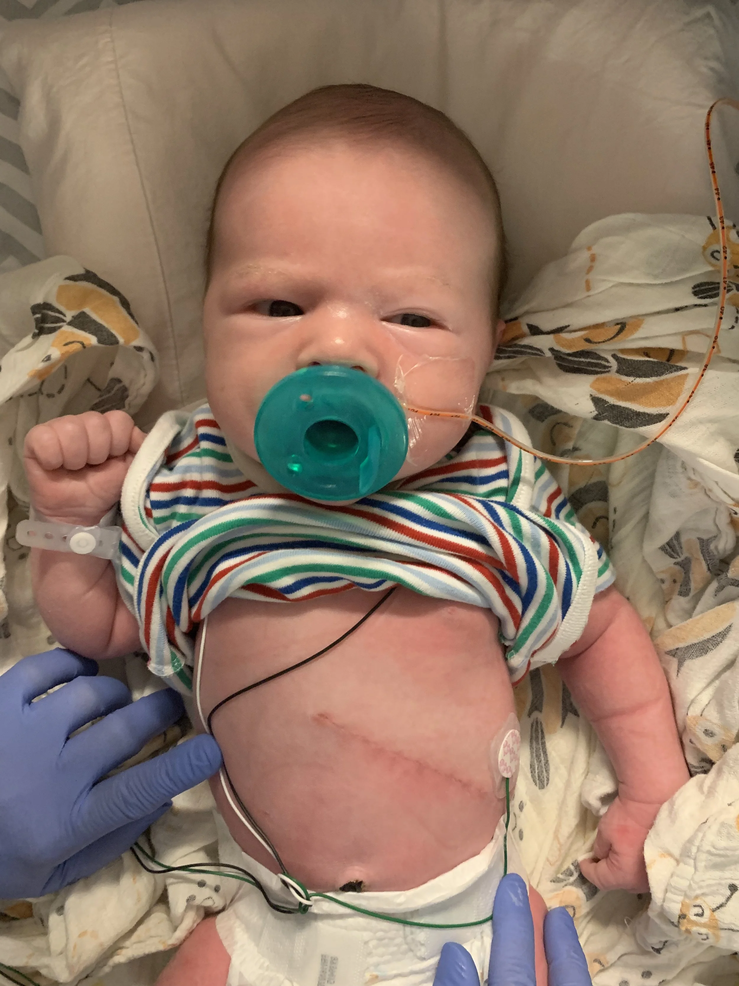 Eli's CDH Story — Tiny Hero: Real Hope for CDH