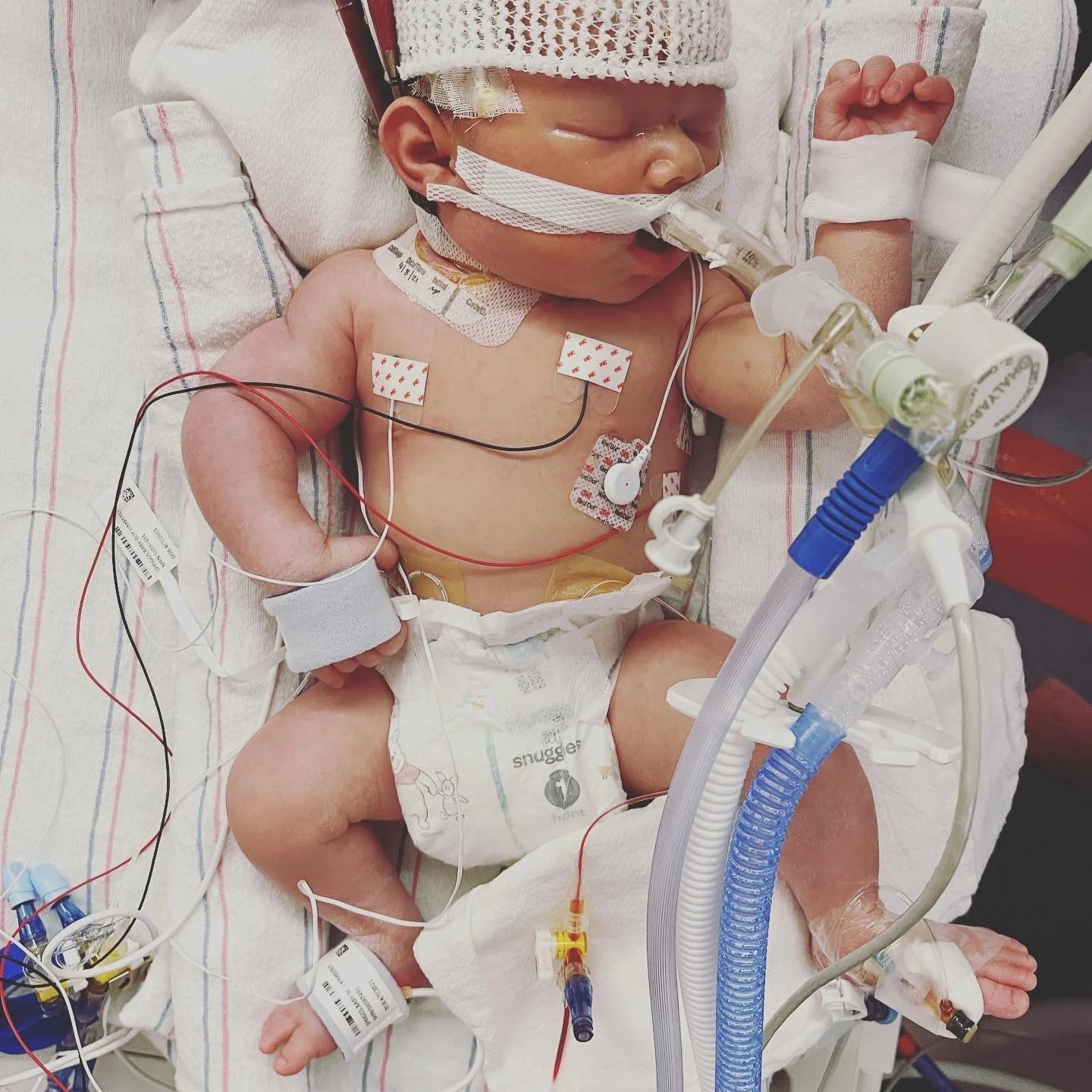 Oliver's CDH Story — Tiny Hero: Real Hope for CDH