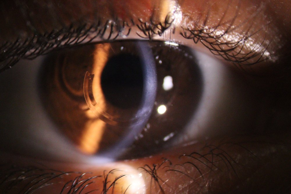 Intracorneal ring segments - vision correction for people with ...