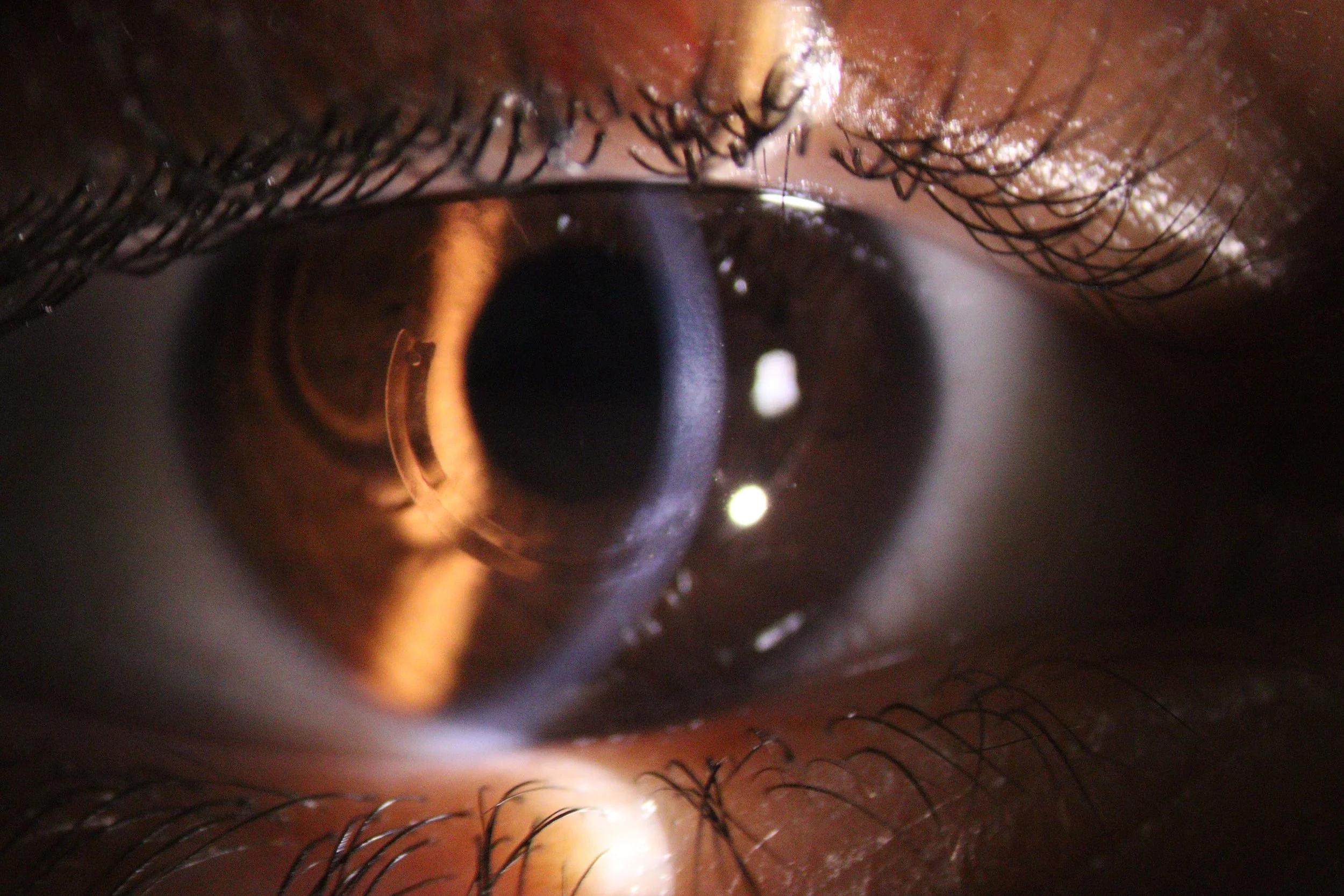 Intracorneal ring segments - vision correction for people with ...