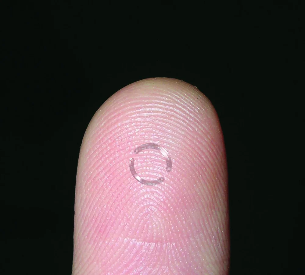 Intracorneal ring segments - vision correction for people with ...