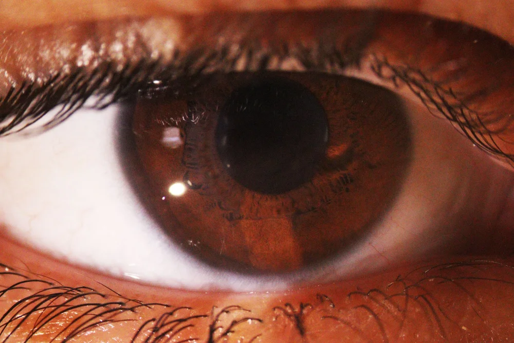 Intracorneal ring segments - vision correction for people with ...