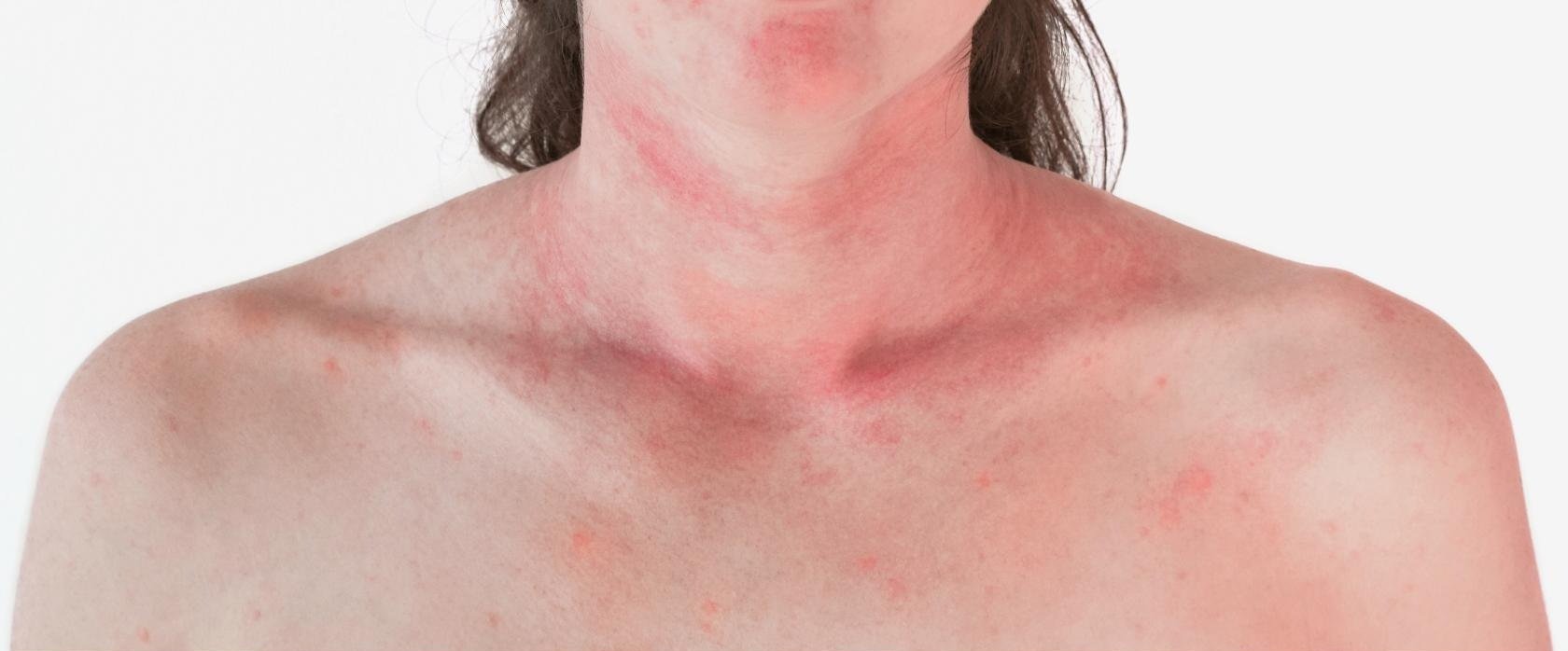 Anxiety Rash Symptoms Treatments And Coping Tips