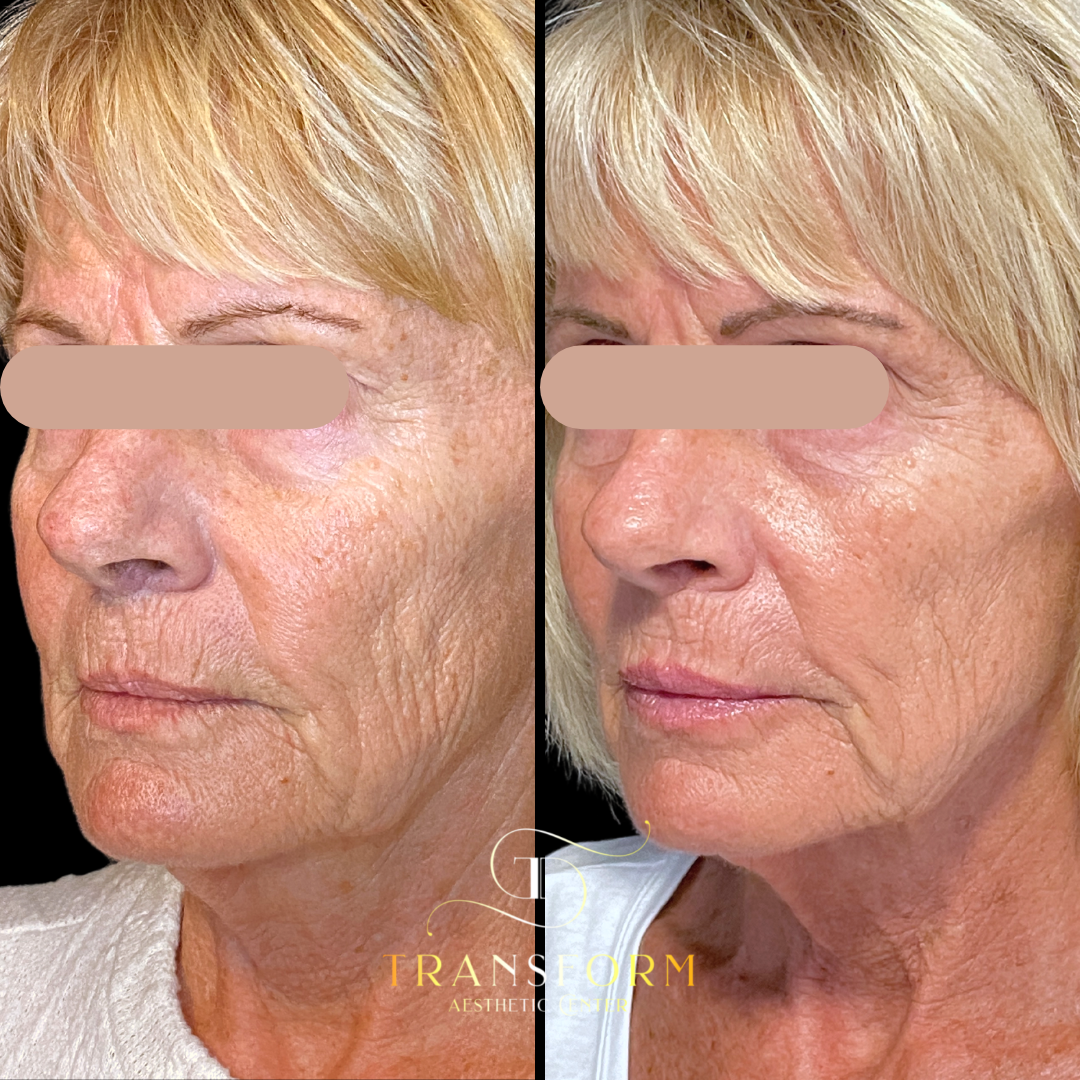 Microneedling and PRP — Transform Aesthetic Center