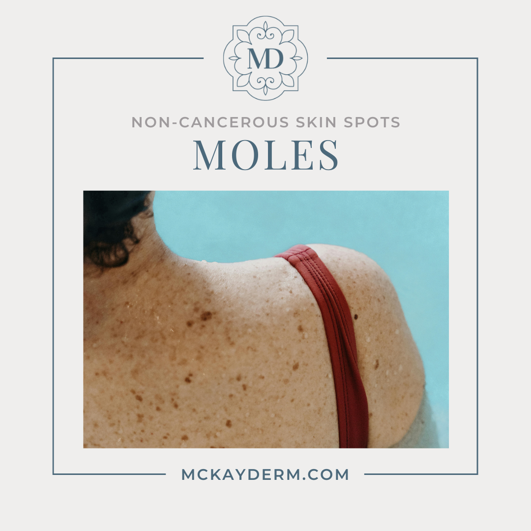 Understanding Non-Cancerous Skin Spots — and When to Consult a ...