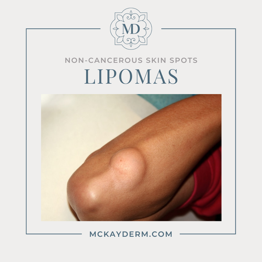Understanding Non-Cancerous Skin Spots — and When to Consult a ...