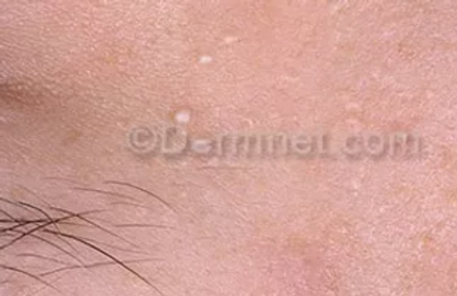 Non-Cancerous Skin Conditions — McKay Dermatology & MedSpa