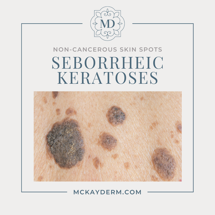 Understanding Non-Cancerous Skin Spots — and When to Consult a ...