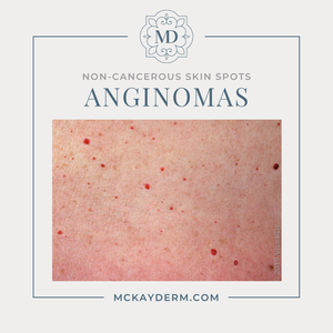 Understanding Non-Cancerous Skin Spots — and When to Consult a ...