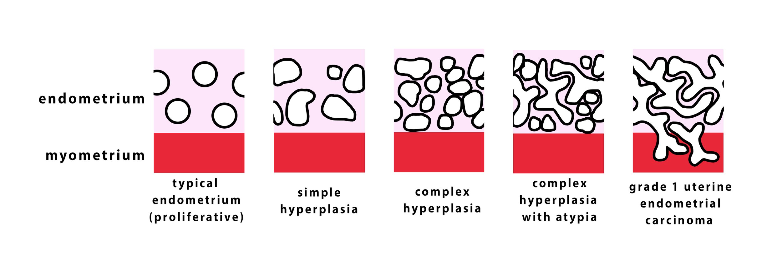Endometrial Hyperplasia — Learn Body Literacy