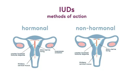 Informed Consent: IUDs — Learn Body Literacy