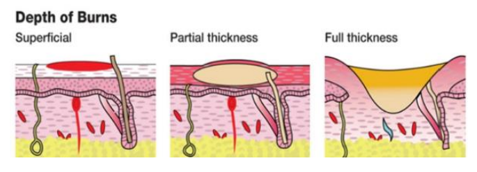 Burn Wounds and The Rule of 9 — Munro Medical Solutions | Medical ...