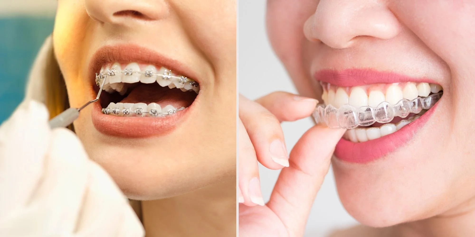 Should I Get Clear Aligners Or Traditional Braces? — Dental On The Bay