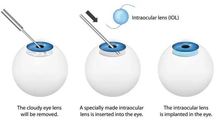 Cataract Surgery Wollongong — Wollongong Eye Doctor | Ophthalmologist ...