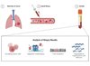 Understanding Tumor Mutational Burden (TMB) — BLOODPAC