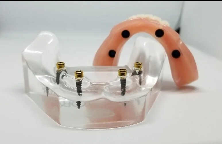 Snap-in Implant Dentures — NASHVILLE DENTURES AND IMPLANTS