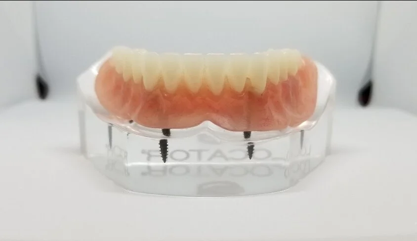 Snap-in Implant Dentures — NASHVILLE DENTURES AND IMPLANTS