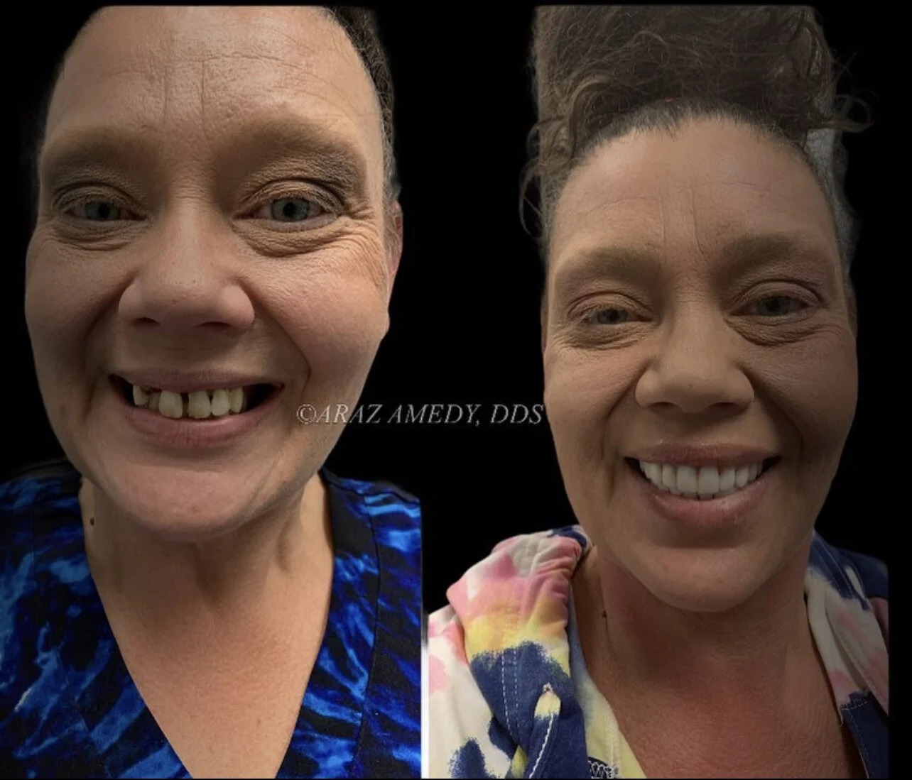 Immediate Dentures — NASHVILLE DENTURES AND IMPLANTS