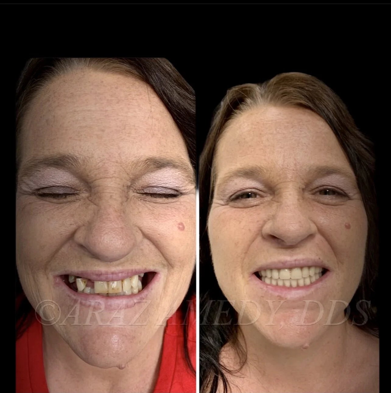 Immediate Dentures — NASHVILLE DENTURES AND IMPLANTS